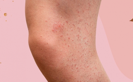 5+ Dermatologist Tips on How To Get Rid of Strawberry Legs